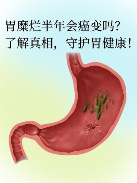 胃糜烂多久会癌变_胃糜烂癌变几率大吗-第1张图片-山城妙识 胃糜烂多久会癌变_胃糜烂癌变几率大吗-第1张图片-山城妙识
