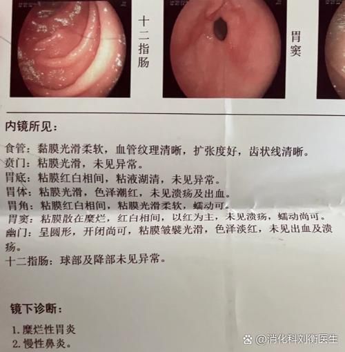 胃糜烂多久会癌变_胃糜烂癌变几率大吗-第2张图片-山城妙识 胃糜烂多久会癌变_胃糜烂癌变几率大吗-第2张图片-山城妙识