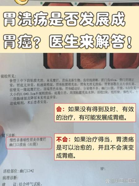 胃糜烂多久会癌变_胃糜烂癌变几率大吗-第3张图片-山城妙识 胃糜烂多久会癌变_胃糜烂癌变几率大吗-第3张图片-山城妙识