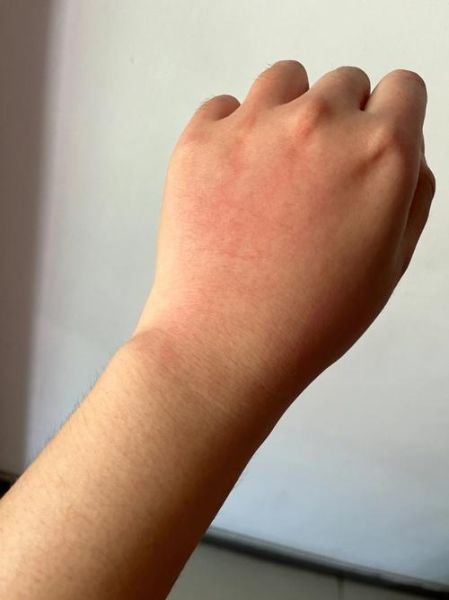 切了山药手特别痒怎么办_山药粘液引起手痒怎么快速止痒-第3张图片-山城妙识