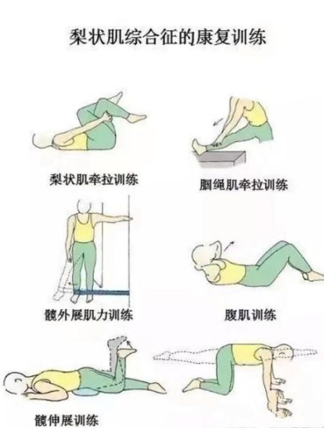 梨状肌综合征的症状有哪些_如何自我判断-第3张图片-山城妙识 梨状肌综合征的症状有哪些_如何自我判断-第3张图片-山城妙识