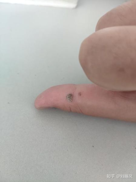 9度米醋治疣步骤_9度米醋去疣多久见效-第3张图片-山城妙识