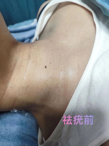 9度米醋治疣步骤_9度米醋去疣多久见效-第1张图片-山城妙识