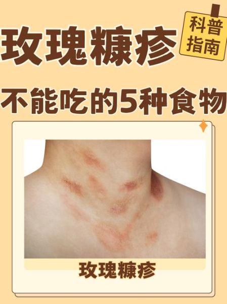 玫瑰糠疹多久能好_玫瑰糠疹会传染吗-第1张图片-山城妙识 玫瑰糠疹多久能好_玫瑰糠疹会传染吗-第1张图片-山城妙识