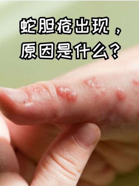 蛇胆疮是什么病_蛇胆疮怎么治疗最快-第1张图片-山城妙识 蛇胆疮是什么病_蛇胆疮怎么治疗最快-第1张图片-山城妙识