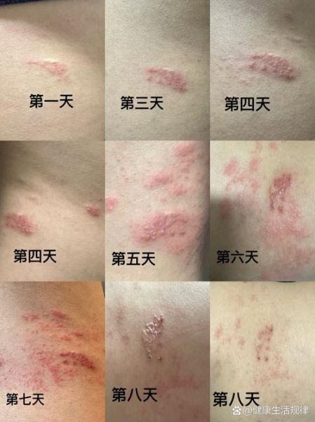 蛇胆疮是什么病_蛇胆疮怎么治疗最快-第3张图片-山城妙识 蛇胆疮是什么病_蛇胆疮怎么治疗最快-第3张图片-山城妙识