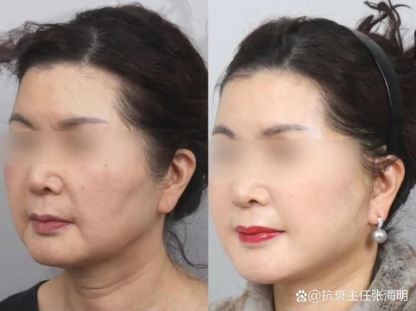 做个拉皮手术大概需要多少钱_拉皮手术价格影响因素-第2张图片-山城妙识 做个拉皮手术大概需要多少钱_拉皮手术价格影响因素-第2张图片-山城妙识