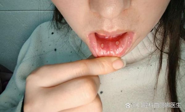 口腔溃疡白色的是什么_白色假膜能抠掉吗-第3张图片-山城妙识 口腔溃疡白色的是什么_白色假膜能抠掉吗-第3张图片-山城妙识