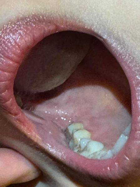 口腔溃疡白色的是什么_白色假膜能抠掉吗-第1张图片-山城妙识 口腔溃疡白色的是什么_白色假膜能抠掉吗-第1张图片-山城妙识