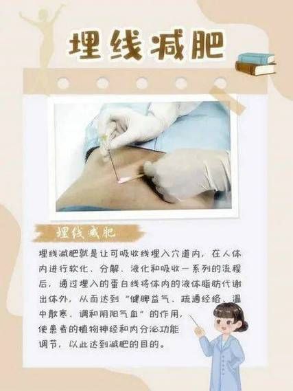 经络埋线减肥多久见效_经络埋线减肥安全吗-第1张图片-山城妙识 经络埋线减肥多久见效_经络埋线减肥安全吗-第1张图片-山城妙识