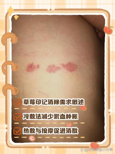 草莓印几天可以消除_如何快速淡化吻痕-第1张图片-山城妙识