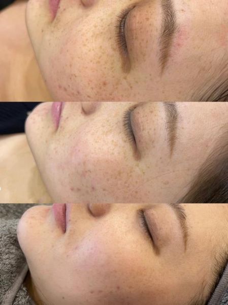 雀斑怎么淡化_雀斑图片对比-第2张图片-山城妙识 雀斑怎么淡化_雀斑图片对比-第2张图片-山城妙识