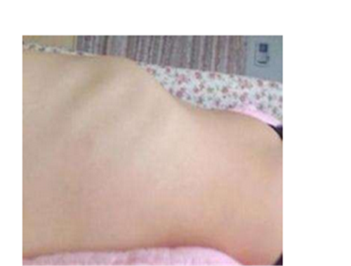 儿童鸡胸病图片_鸡胸矫正最佳年龄-第2张图片-山城妙识 儿童鸡胸病图片_鸡胸矫正最佳年龄-第2张图片-山城妙识