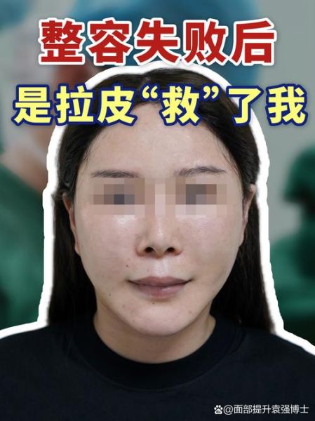 拉皮手术失败图片_如何避免拉皮失败-第2张图片-山城妙识 拉皮手术失败图片_如何避免拉皮失败-第2张图片-山城妙识