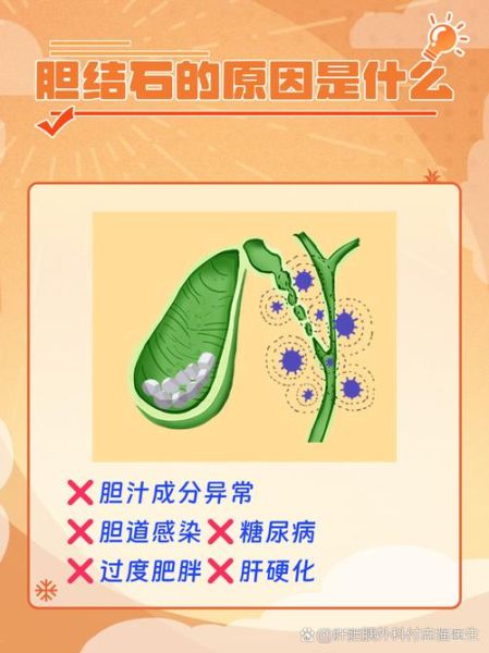 胆结石是怎么形成的_胆结石形成的原因有哪些-第1张图片-山城妙识 胆结石是怎么形成的_胆结石形成的原因有哪些-第1张图片-山城妙识