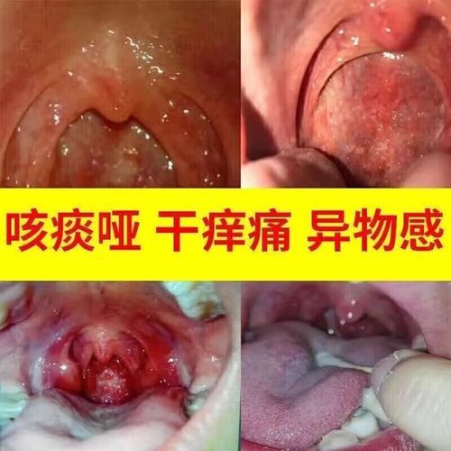 扁桃体发炎吃什么药_扁桃体肿大能自愈吗-第1张图片-山城妙识 扁桃体发炎吃什么药_扁桃体肿大能自愈吗-第1张图片-山城妙识