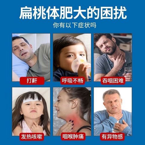 扁桃体发炎吃什么药_扁桃体肿大能自愈吗-第3张图片-山城妙识 扁桃体发炎吃什么药_扁桃体肿大能自愈吗-第3张图片-山城妙识