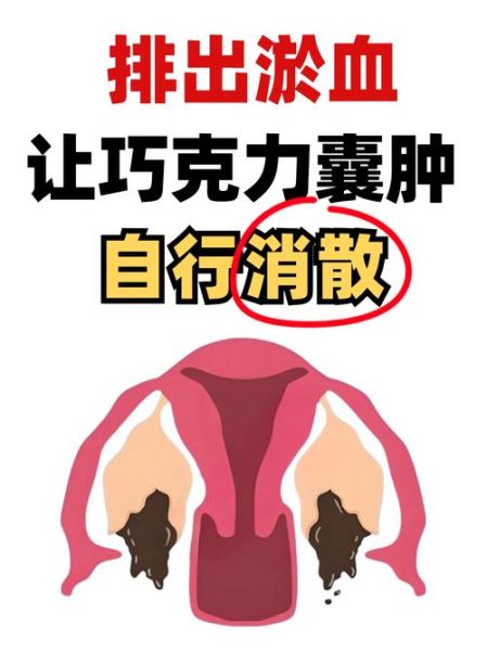 巧克力囊肿会影响怀孕吗_巧克力囊肿怎么治疗最好-第3张图片-山城妙识 巧克力囊肿会影响怀孕吗_巧克力囊肿怎么治疗最好-第3张图片-山城妙识